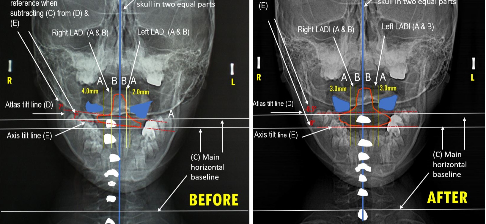 Improvement In Cervical Spinal Misalignment After The Application Of